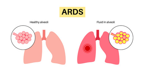 Ards anatomical poster Royalty Free Vector Image