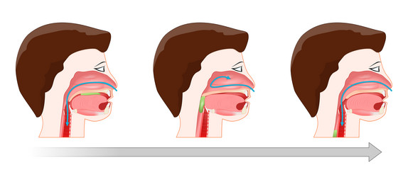 Dysphagia Vector Images (over 220)