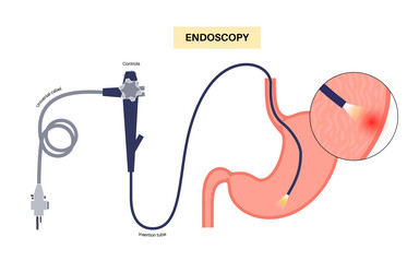 Gastroscopy endoscopy procedure Royalty Free Vector Image