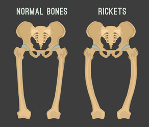 Rickets scheme Royalty Free Vector Image - VectorStock