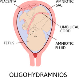 Polyhydramnios excess amniotic fluid Royalty Free Vector