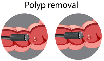 Diagram showing removal of polyps Royalty Free Vector Image