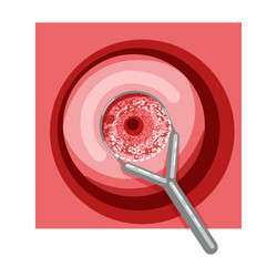 Pap Smear Vector Images (over 100)