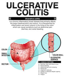 Ulcerative colitis symptoms infographic Royalty Free Vector