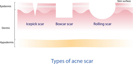 Acne Scar Vector Images (over 1,100)