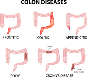 Proctitis Vector Images (28)