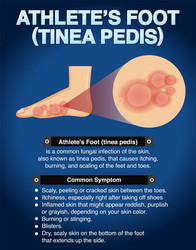Informative poster of ringworm Royalty Free Vector Image