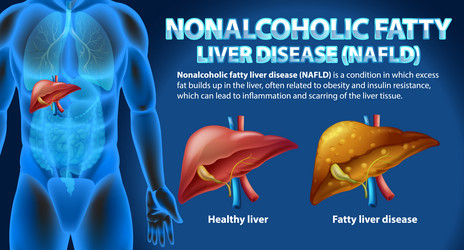 Nafld Vector Images (33)