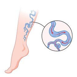Varicose veins blue blood vessel visible through Vector Image