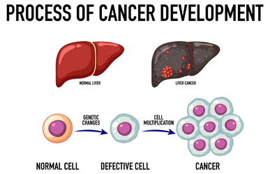 Liver cancer diagram in detail Royalty Free Vector Image