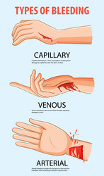 Human hand with different types of bleeding Vector Image