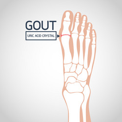 Gout logo icon Royalty Free Vector Image - VectorStock