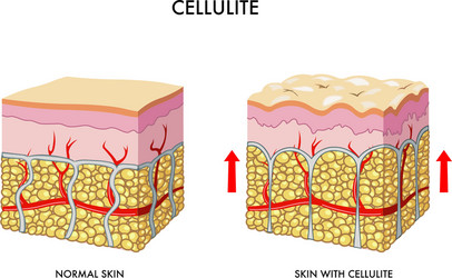 Cellulite Vector Images (over 3,900)