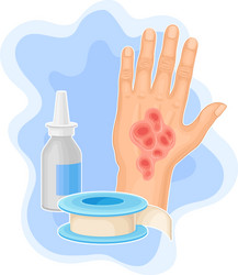 First aid for hand with ambustion or burn Vector Image