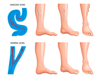 Varicose veins realistic infographics Royalty Free Vector