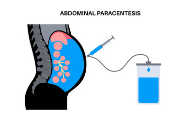 Paracentesis Vector Images (33)