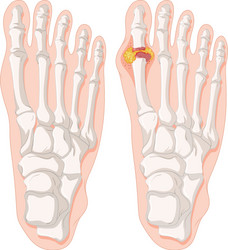 Gout Vector Images (over 830)