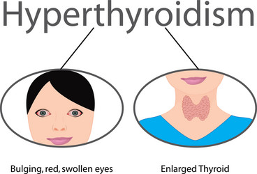 Causes of hyperthyroidism the thyroid gland Vector Image