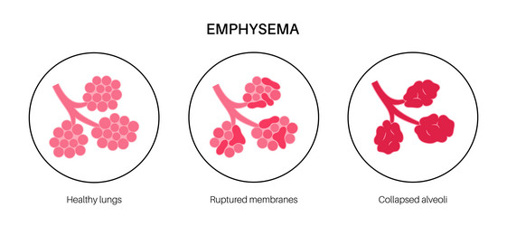 Emphysema Anatomy & Pathology Royalty Free Vector Image