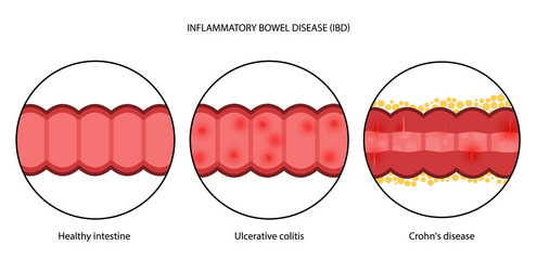 Inflammatory Bowel Disease Vector Images (over 140)