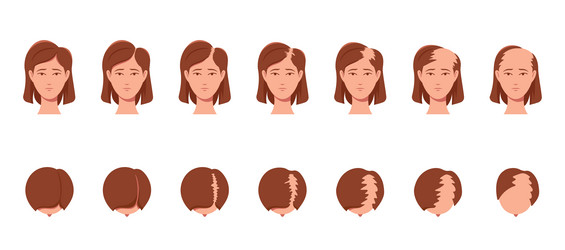 Hair loss graph of four stages alopecia Royalty Free Vector