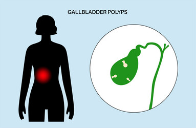 Gallbladder polyp anatomy Royalty Free Vector Image