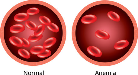 Anemia blood of healthy human and vessel Vector Image