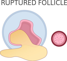 Medical diagram of 2 stages prostate cancer Vector Image