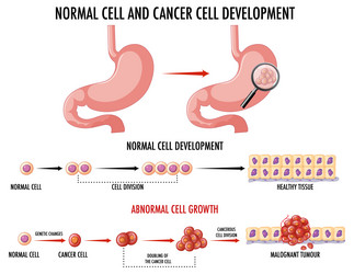 Diagram showing cancer development process Vector Image