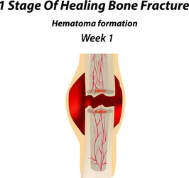 2 stage of healing bone fracture formation Vector Image
