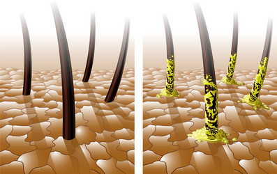 Greasy Hair Vector Images (27)