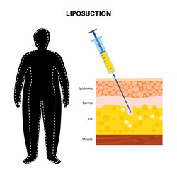 Liposuction surgery procedure Royalty Free Vector Image