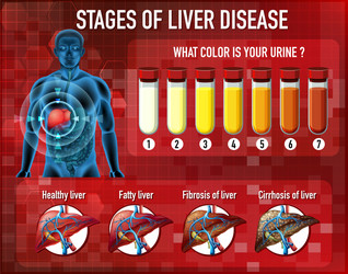 Stages liver disease Royalty Free Vector Image