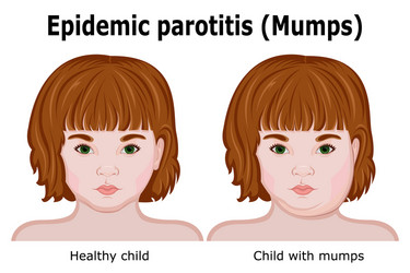 A child with rubella Royalty Free Vector Image