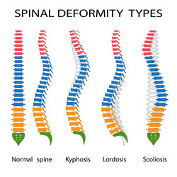 Types scoliosis c s z shaped Royalty Free Vector Image