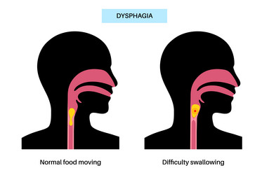 Dysphagia medical poster Royalty Free Vector Image
