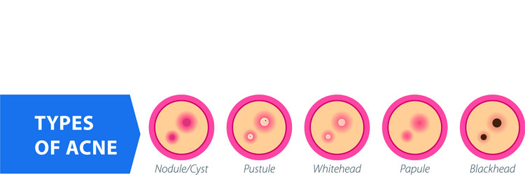 Acne Cartoon Vector Images (over 1,200)