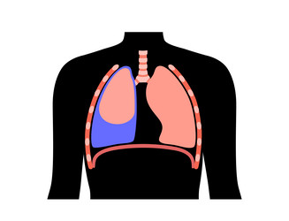 Pleural effusion poster Royalty Free Vector Image