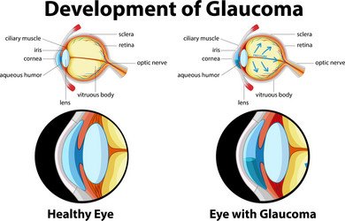 Glaucoma cross section of a human eye Royalty Free Vector