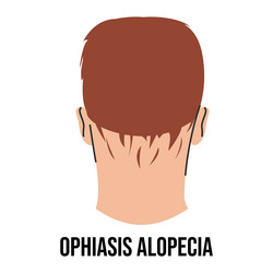 Diffuse alopecia areata disease isolated Vector Image