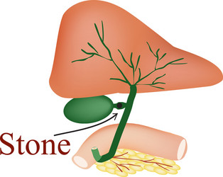 Gallbladder Stone Vector Images (over 140)