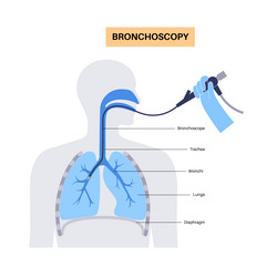 Bronchoscopy procedure concept Royalty Free Vector Image