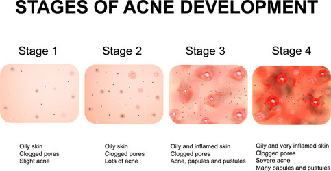 Types acne skin inflammation pimples boils Vector Image