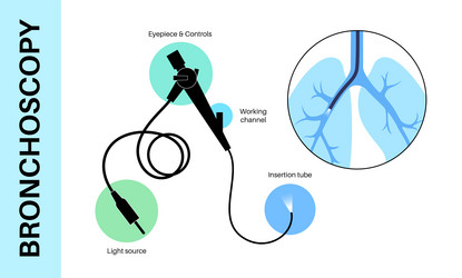 Bronchoscopy procedure concept Royalty Free Vector Image
