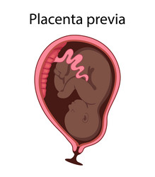 Placenta Cartoon Vector Images (over 110)