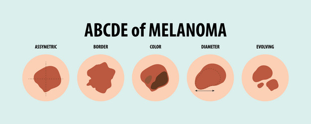 Guide to five types of skin cancer Royalty Free Vector Image