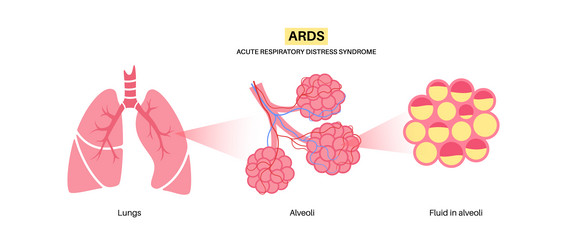 Ards anatomical poster Royalty Free Vector Image