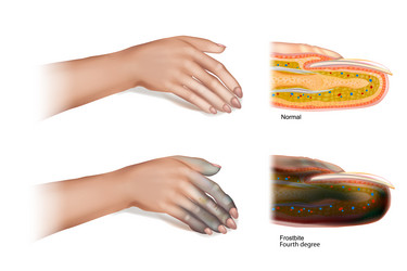 Frostbite third degree skin injury that occurs Vector Image