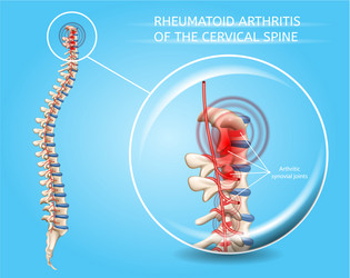 Spine disease normal backbone Royalty Free Vector Image