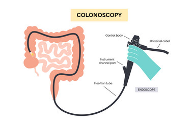 Sigmoidoscopy medical procedure Royalty Free Vector Image